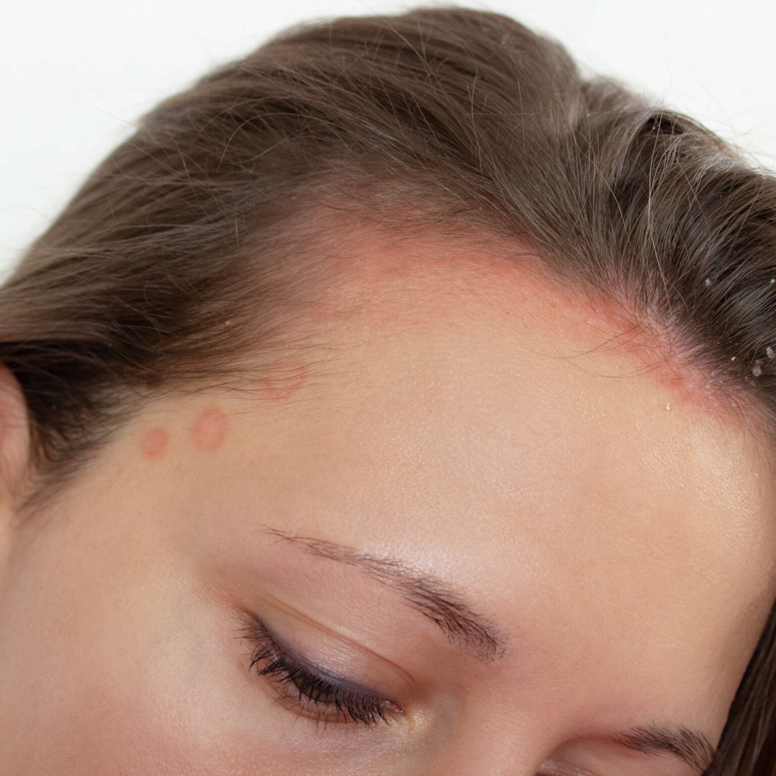 Psoriasis du cuir chevelu